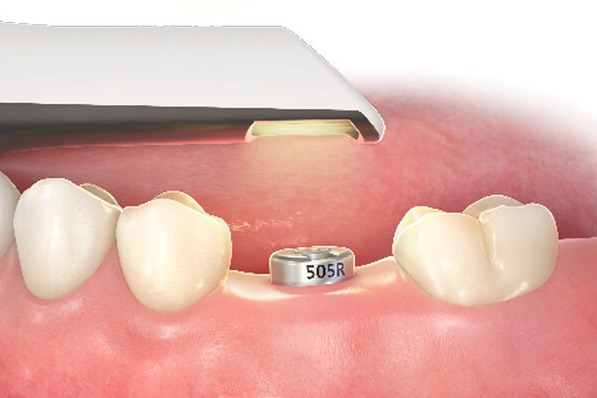 완성된 디지털 지도... “TS 이어 KS, SS, US용 Scan Healing Abutment 출시”