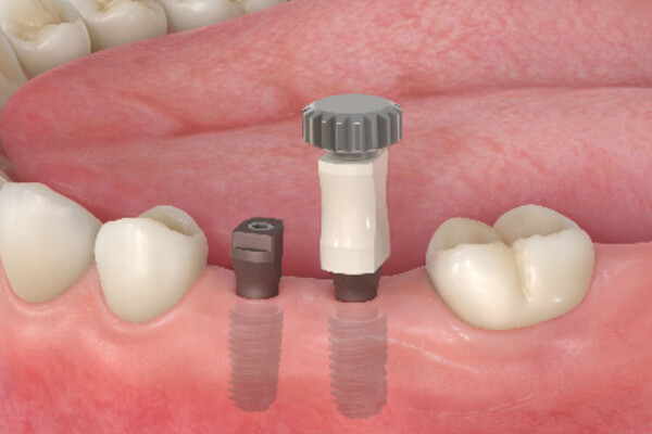 완성된 디지털 지도... “TS 이어 KS, SS, US용 Scan Healing Abutment 출시”