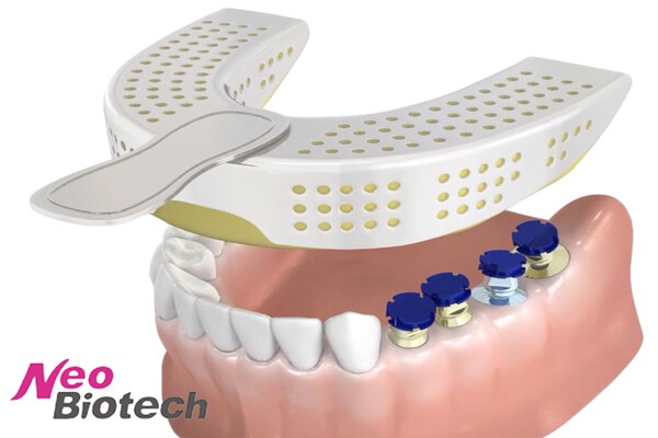 네오 ‘PickCap Impression Coping’... “정확성, 편리성, 경제성 등 개원가 호평!”