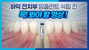 골폭 좁은 하악 전치부엔... “MS 임플란트 전용 ‘MS KIT’를 소개합니다!”