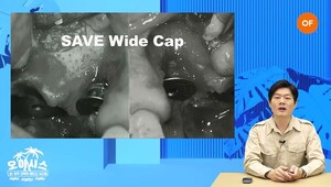 덴티스 ‘Save Wide Cap’... “Bending 가능한 GBR Tool, 최근 FDA 승인!”